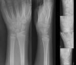 Rx: Scaphoidfraktur Scaphoid bone fracture
