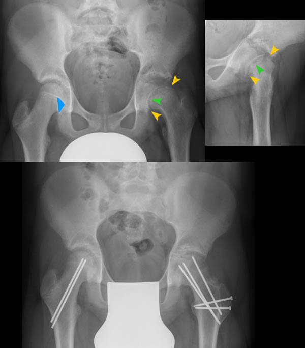 Bild 11/60 - Röntgenbild Radiograph : Chronische Epiphysiolysis capitis ...