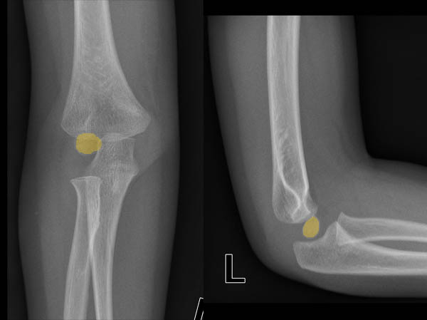 Röntgenbild Der Ellenbogenknochen
