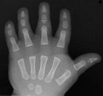 Rx: Brachymesophalangie