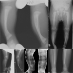 Rx: Crus varum congenitum