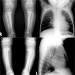 Rx: Floride Rachitis
