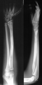 Rx: Chronische Osteomyelitis