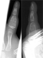 Rx: Aneurysmatische Knochenzyste
