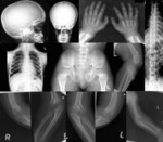 Rx: Achondroplasie