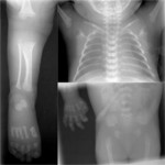 Rx: Achondroplasie