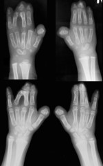Rx: Apert-Syndrom, Syndaktylie