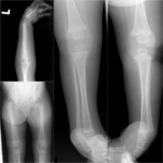 Rx: Arthrogryposis multiplex congenita