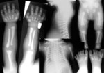 Rx: Chondroektodermale Dysplasie