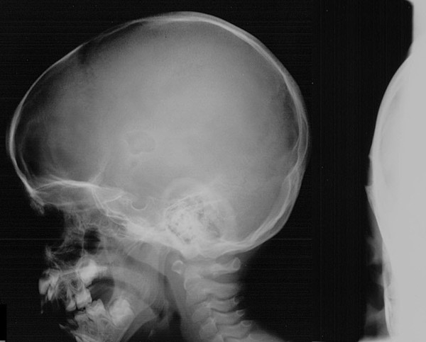 PediRad