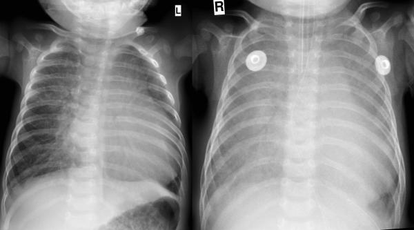 Herzgrösse in der Norm. Gering verbreitertes Mediastinum bei bekannter ...