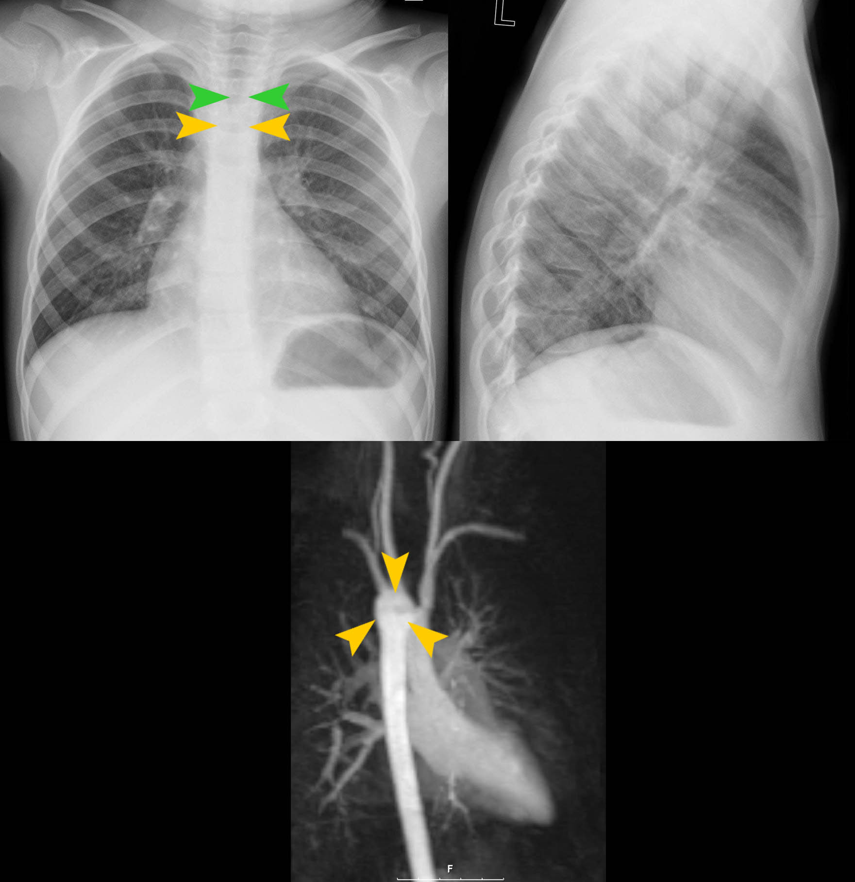 Kein Anhaltspunkt für Pneumonie.