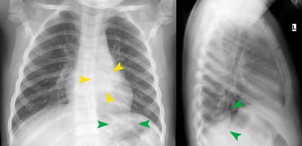 Kein Anhaltspunkt für Pneumonie.