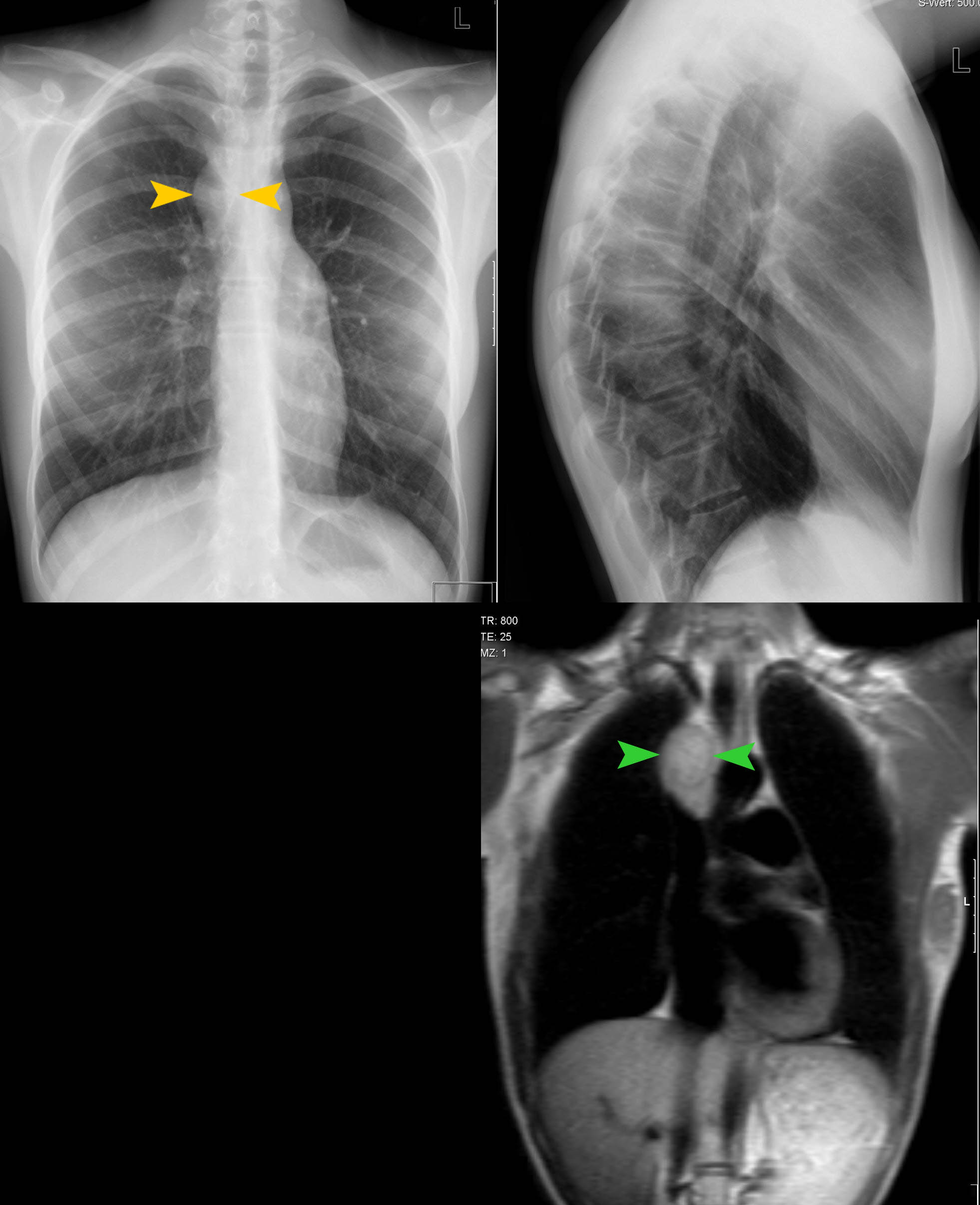 Thoraxapertur Rare Diseases Of Larynx, Trachea And Thyroid. Abstract
