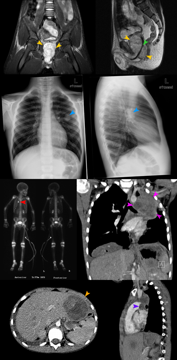 Thoraxapertur Rare Diseases Of Larynx, Trachea And Thyroid. Abstract