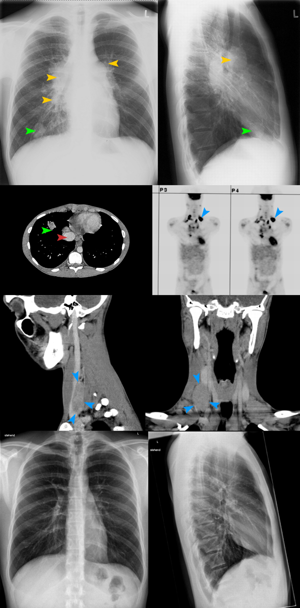Thoraxapertur Rare Diseases Of Larynx, Trachea And Thyroid. Abstract
